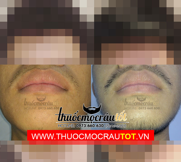 Thuốc Mọc Râu Minoxidil 5 Dạng Lỏng Combo Beard Oil 20ml