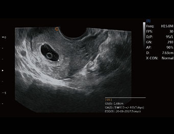 Máy Siêu Âm Màu 5D HD Chison CBit 6 Màn Hình Kép