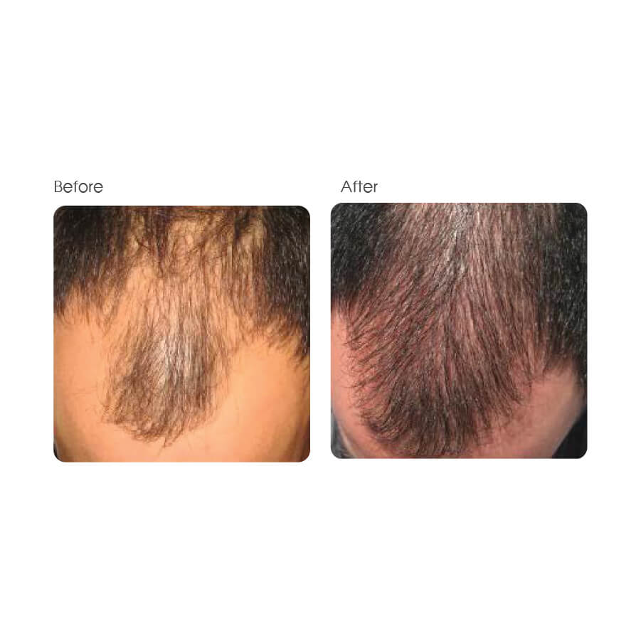 MD:COMPLEX HAIR-REVIT CX / MESO CHỐNG RỤNG & MỌC TÓC | Pharma Cosmetics