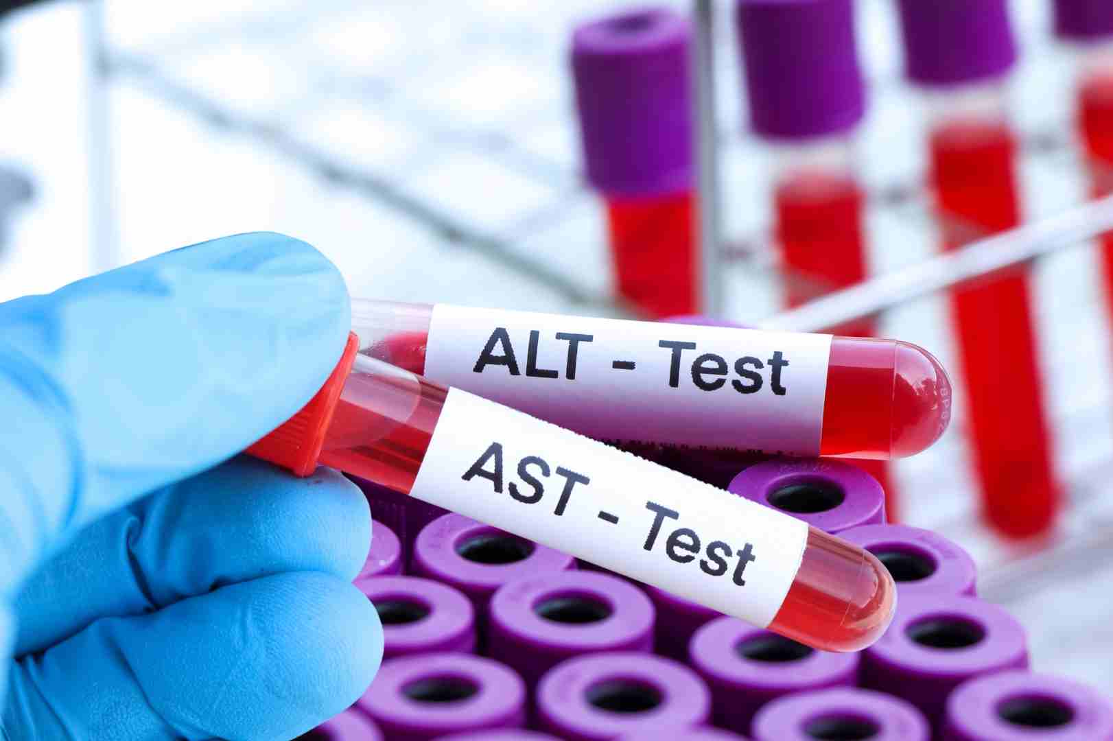 Men gan bình thường bao nhiêu? 3 dấu hiệu cảnh báo gan đang gặp nguy