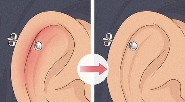 Bị bump lỗ xỏ phải làm sao? Bật mí cách xử lí bằng nước muối