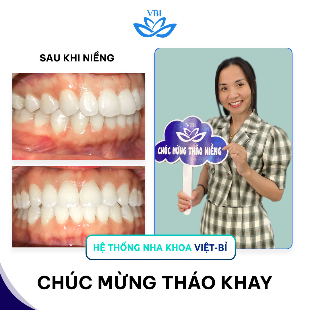 Khay niềng trong suốt: Giải pháp thẩm mỹ của niềng răng hiện đại