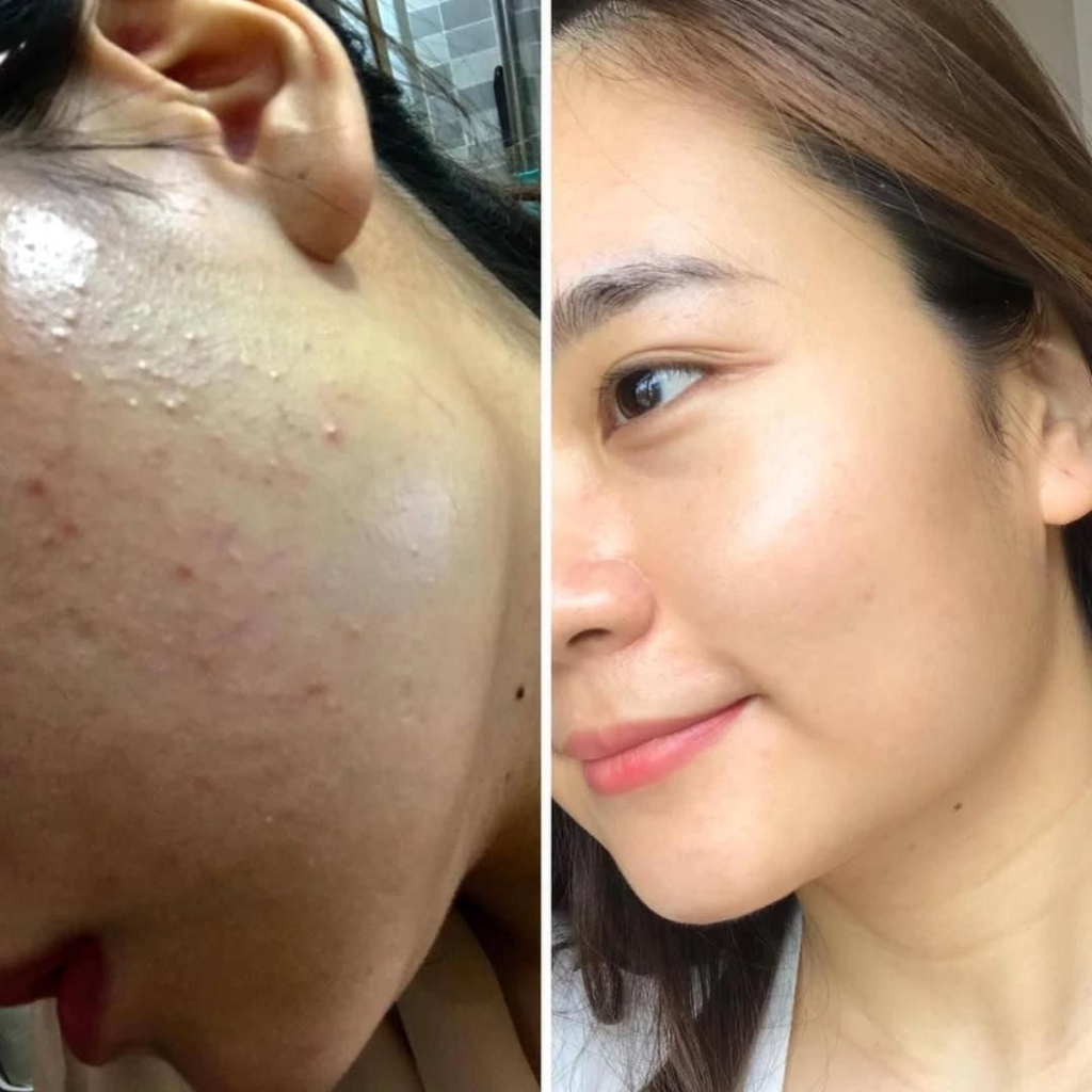 Thực Phẩm Chức Năng Biotrade Acnaut Food Supplement With Brewer's Yeast ...