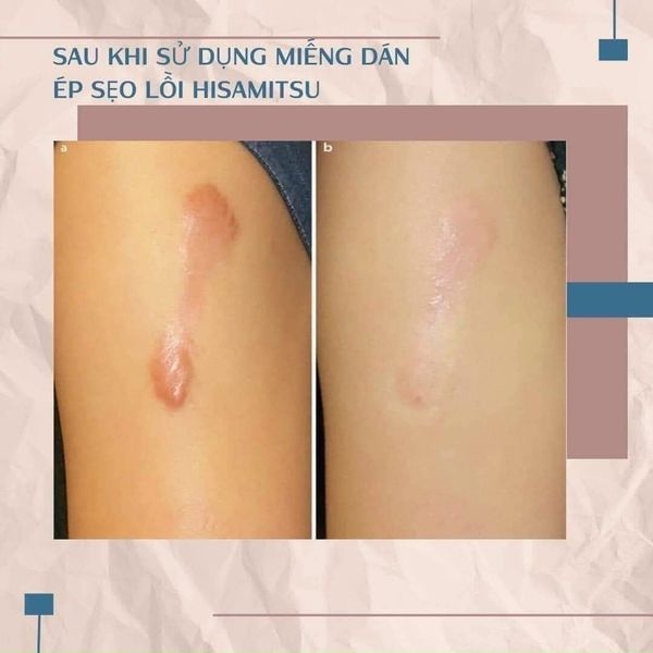 Miếng dán trị sẹo lồi, mụn thâm, mụn bọc ECLAR PLASTERS HISAMITSU