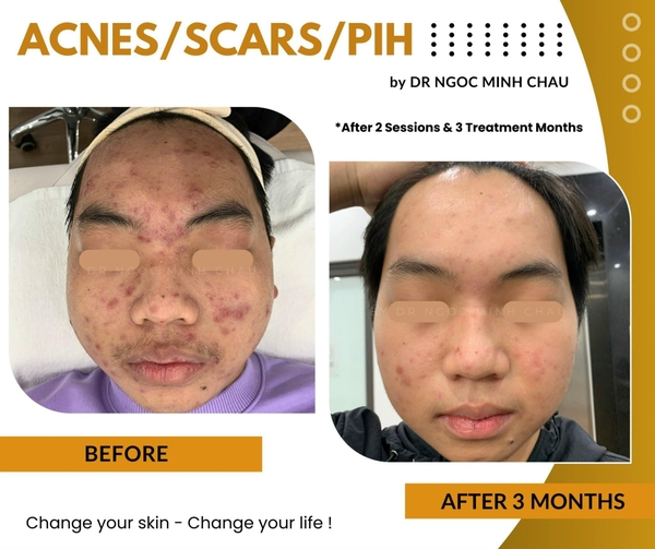 ACNES/ SCAR/ PIH - by Dr Ngoc Minh Chau NMCPHARMA
