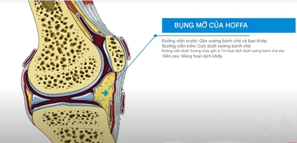 VIÊM MỠ HOFFA LÀ GÌ? NGUYÊN NHÂN GÂY ĐAU GỐI ÍT NGƯỜI BIẾT!