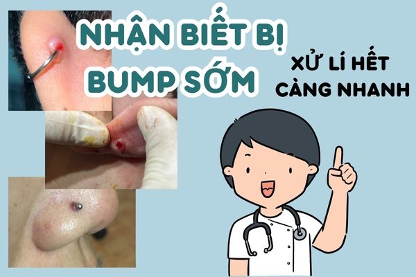 Nhận biết bị bump khi xỏ khuyên sớm xử lí càng nhanh hết