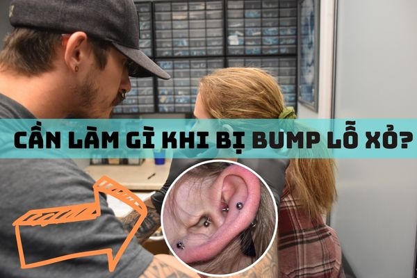 Bị bump lỗ xỏ phải làm sao? 2 cách xử lí bằng nước muối