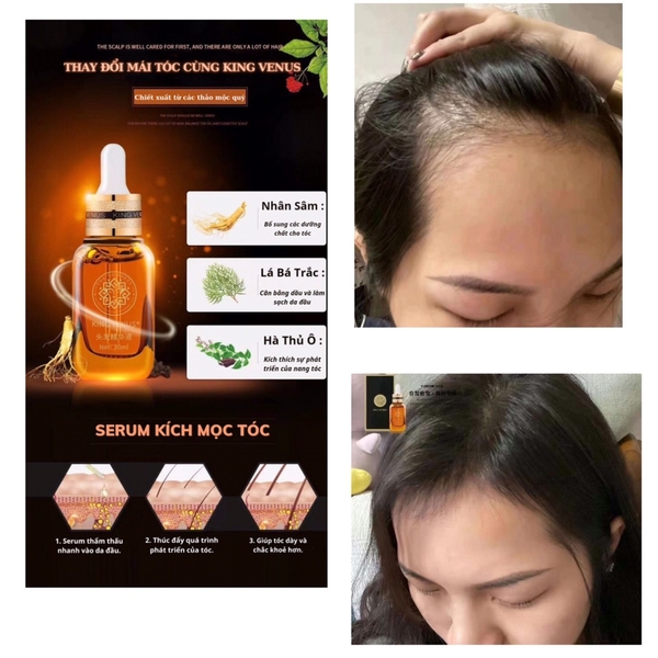 [Chính Hãng] Serum KÍCH MỌC TÓC King Venus (Vs mới của zzVenus): 100% ...