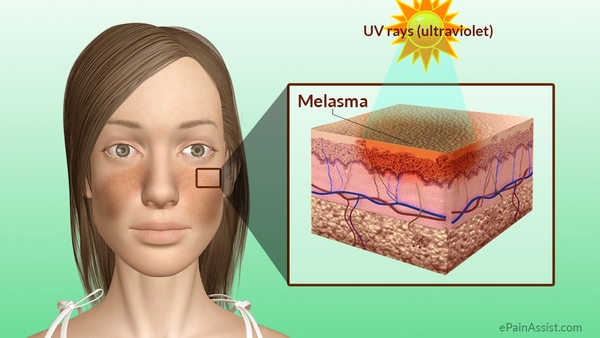 Top Melasma Treatment in Saudi Arabia ( Riyadh )